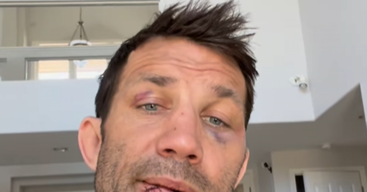 Fight Site - (VIDEO) Rockhold pokazao polomljene zube nakon meča s ... Fight Site - (VIDEO) Rockhold pokazao polomljene zube nakon meča s ...